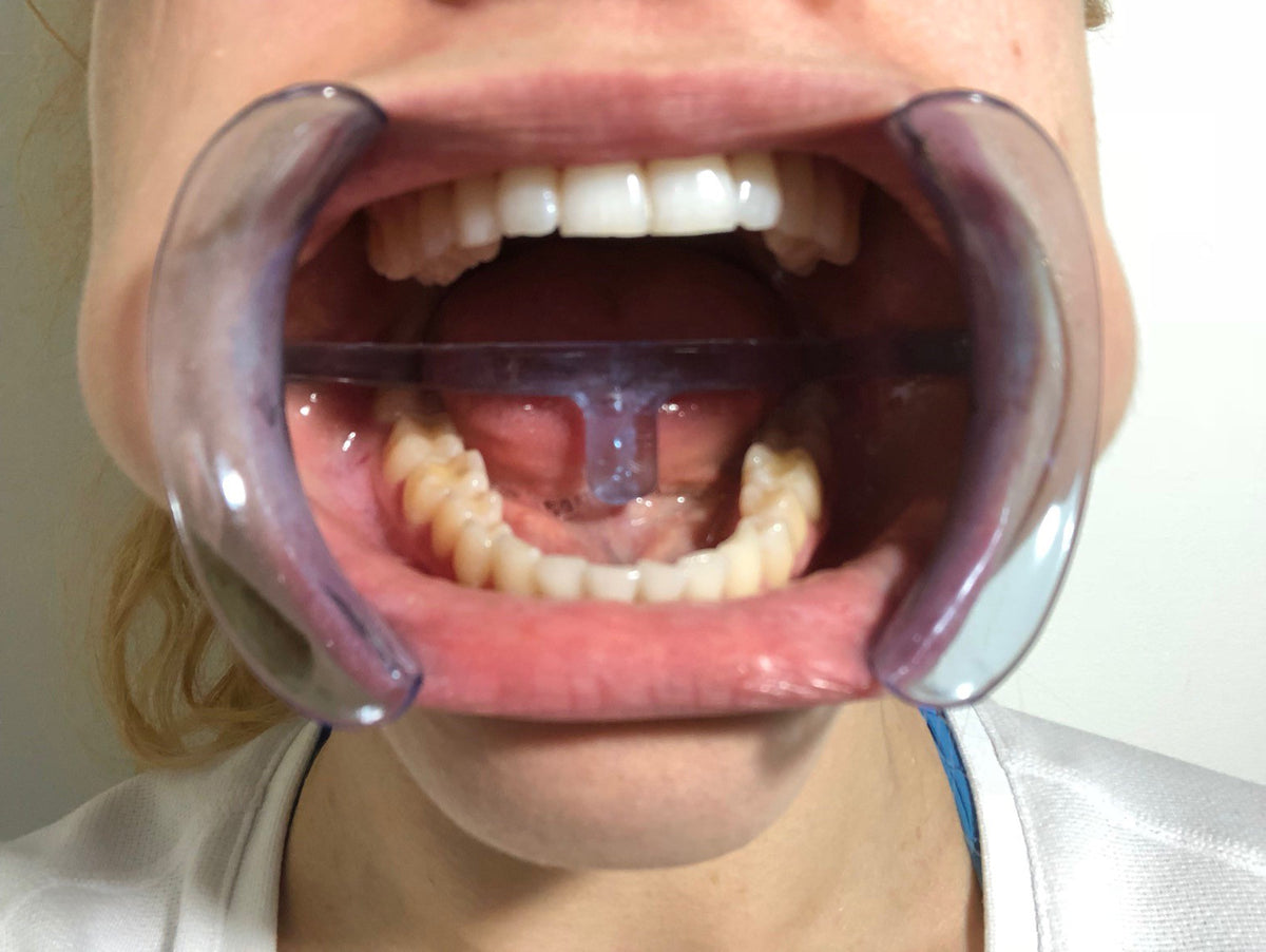 Extraoral Cheek Retractors, Kids, 992682 | numedical